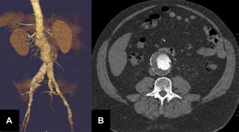 A Posteroanterior Three Dimensional Reconstruction Of Complex
