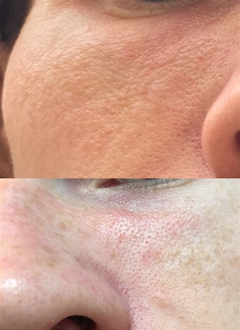 Bumpy Texture On Face