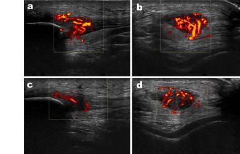 High Resolution Colour Doppler Ultrasound Of Patellar Tendinopathy A