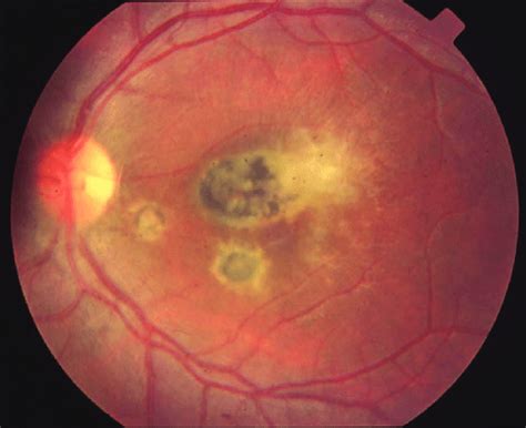 Fundus Photograph Of Left Eye Showing Active Chorioretinitis Of Ocular