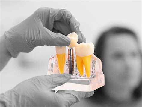Implantes Dentários Em Carga Imediata Tudo Que Precisa Saber