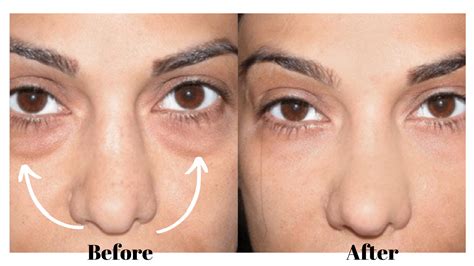 Fat Injections Under Eyes How To Do It Right