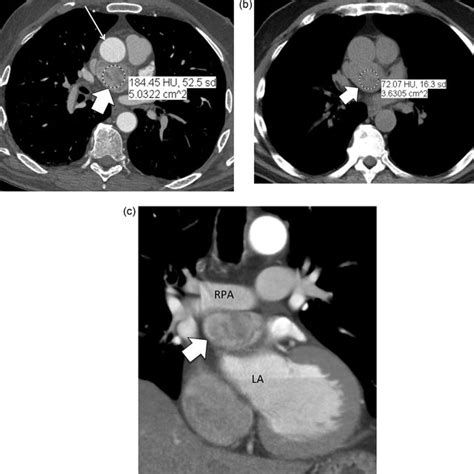 Axial Contrast Enhanced A And Noncontrast B Computed Tomography