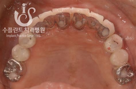 임플란트중심 수플란트치과병원