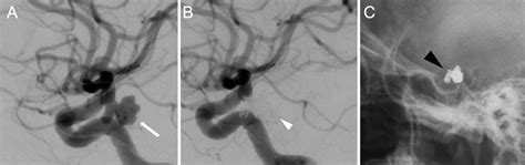Presence Of Intra Aneurysmal Thrombi With Delayed Coil Migration After