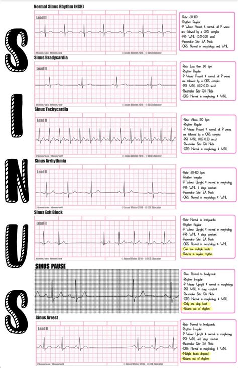 Ekg Need To Knows Nursing Emt Paramedic Cardiology Etsy