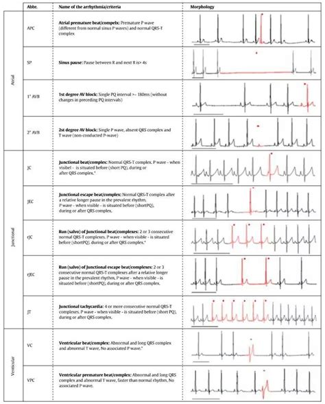 Visual Arrythmia Chart Vet Medicine Veterinary Medicine Vet Tech