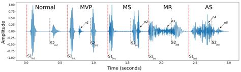 Retracted A Novel Deep Learning Cnn For Heart Valve Disease