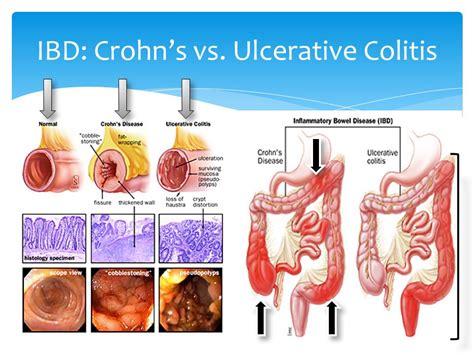 Inflammatory Bowel Disease Ibd Ulcerative Colitis And Crohns Disease My XXX Hot Girl