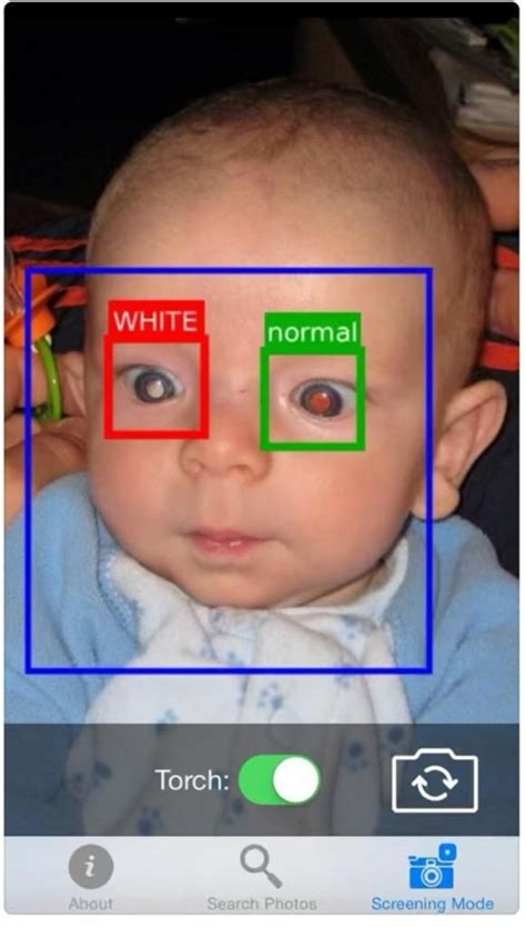 O que é RETINOBLASTOMA Retinoblastoma tem cura Entenda a doença da