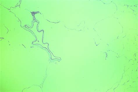 Section Of Emphysematous Lung In Which There Is Destruction Of Alveolar