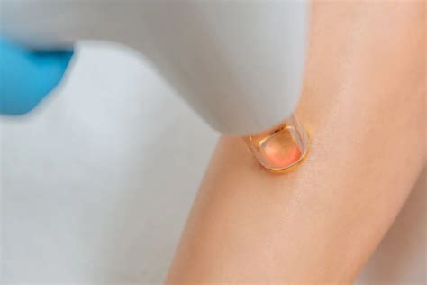 What Practitioners Need To Know About Pulsed Dye Lasers Laser Service