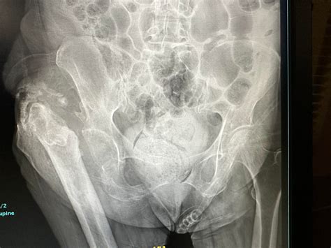 Hip Hipohno Rradiology
