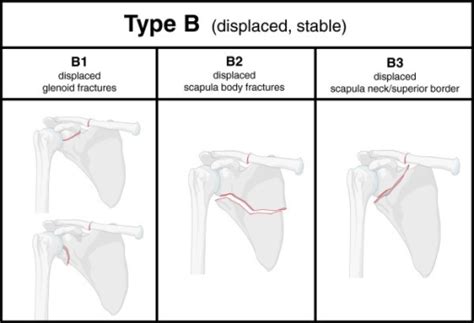 Classification Of Displaced Fractures Of The Scapula Wi Open I