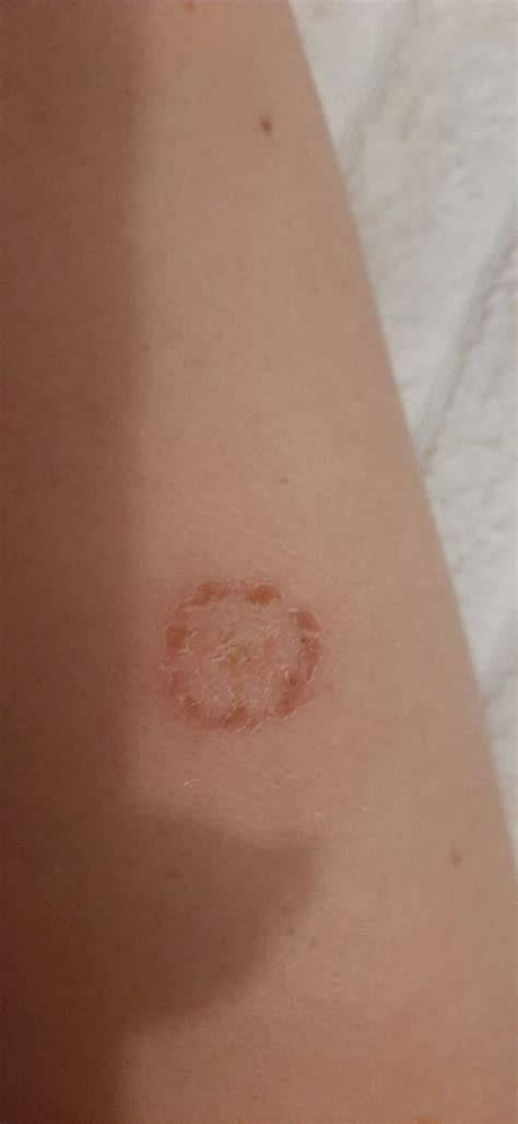 Skin Mycoses Icd10 B35 B49 Online Consultation Ai Dermatologist