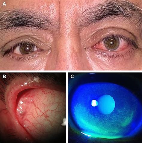 What Is Orbital Myositis At Victoria Jenkins Blog