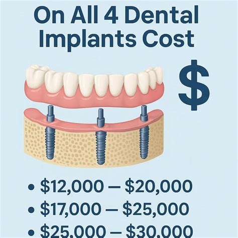 On All 4 Dental Implants Cost Complete 2025 Guide 💎
