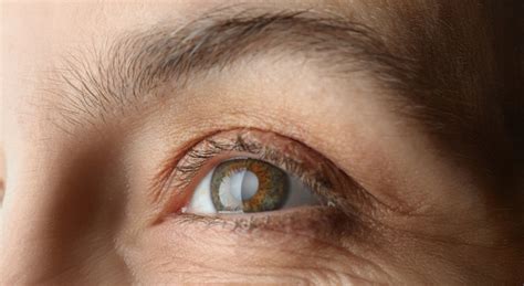Eye Diseases Linked To Sun Damage Ophthalmologist In Rapid City SD Slingsby Huot Eye