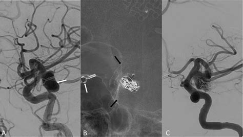 A Digital Subtraction Angiography Dsa Demonstrating A Lobulated