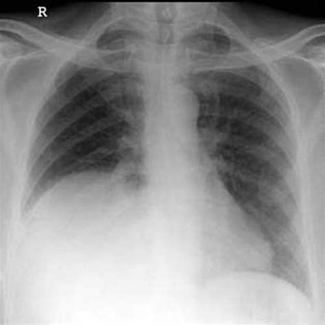 Elevated Diaphragm Lung Chest X Ray Showing An Elevated Right