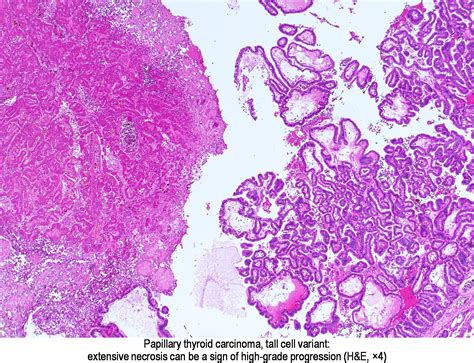 Pathology Outlines Papillary Carcinoma Tall Cell Variant