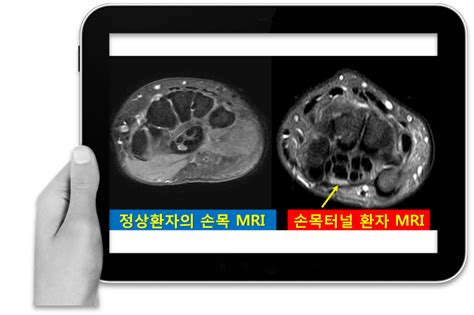 정중신경 손상에 의한 손목터널증후군 수부외과의 내시경치료 네이버 블로그