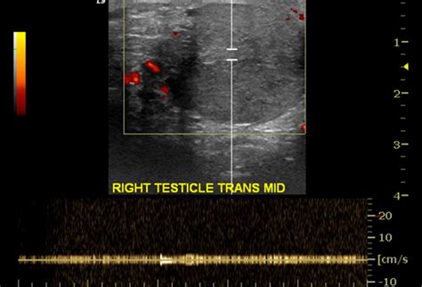 Testicular Disorders Trouble Doesnt Always Come In Pairs
