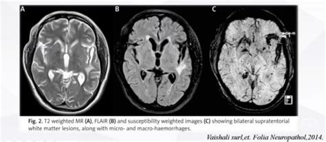 【学术报告整理】cns免疫介导性血管炎影像与鉴别——解放军总医院第六医学中心神经内科主任医师刘建国教授分享 脑医汇