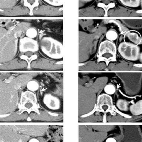 Pdf Successful Distal Gastrectomy After Distal Pancreatectomy