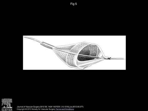 Current Update Of Cerebral Embolic Protection Devices Ppt Download