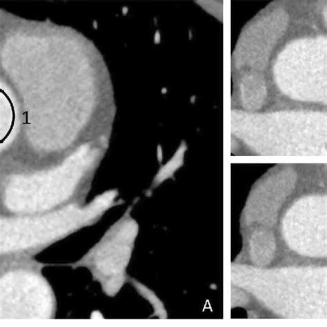 Regions Of Interest Are Manually Drawn In The Aorta A Proximal Lad