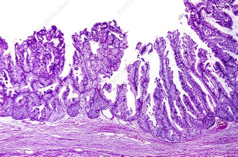 Ovarian Tumour Light Micrograph Stock Image C0066865 Science