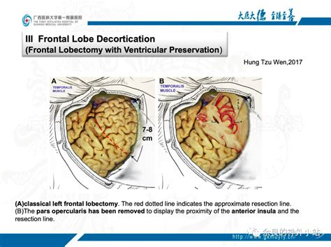神外基本功：额叶切除术 脑医汇
