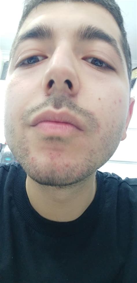 I Have Folliculitis On My Face Please Help R Folliculitis