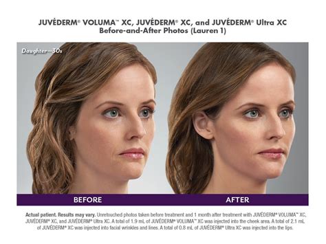 Juvederm Fillers — Plump Medical Spa