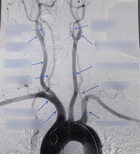 Aortic Arch Labeling Diagram Quizlet