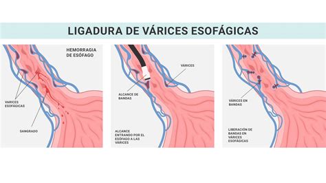 Daniel Bisogno Fue Hospitalizado ¿qué Son Las Várices En El Esófago