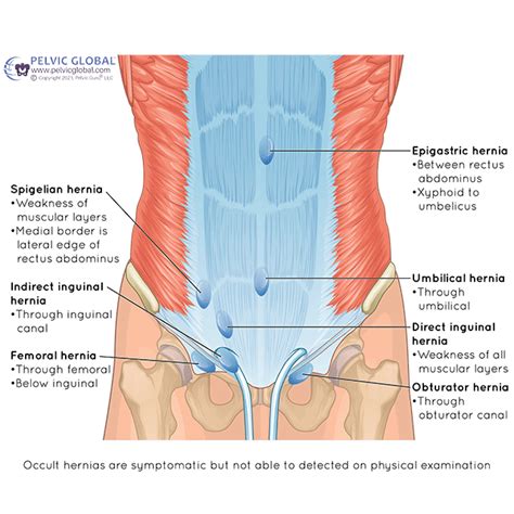 What Is A Postpartum Umbilical Hernia