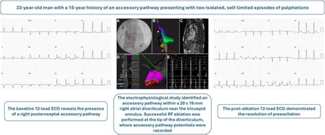 High Risk Accessory Pathway Associated With A Rare Right Atrial