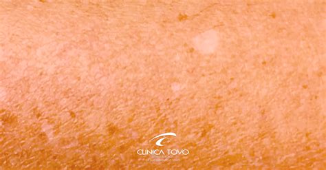 Tratamento Da Sardas Brancas Leucodermia Puntata Nos Braços E Pernas