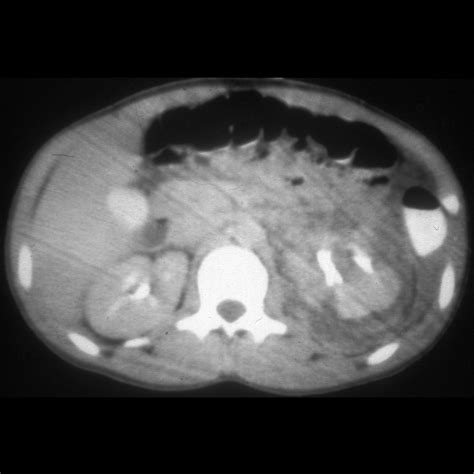 School Ager In A Motor Vehicle Accident Pediatric Radiology Case