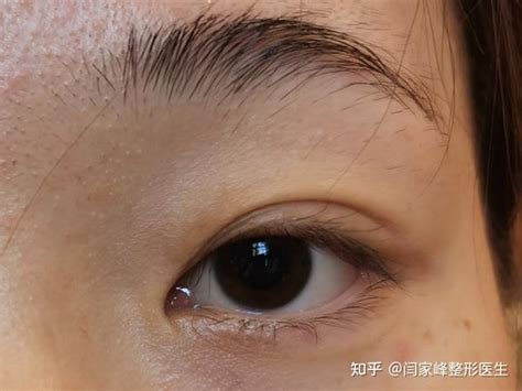 上睑下垂的诊断标准和分类 知乎
