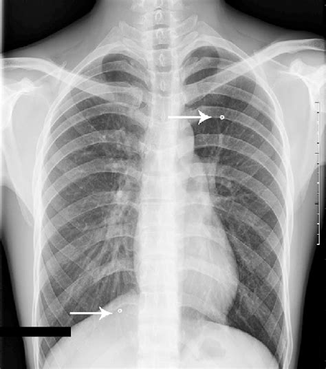 Are Embolization Coils Safe For Mri Mapasgmaes