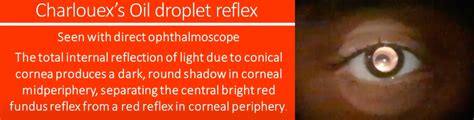 Annular Dark Shadow Assessment Useful In Diagnosing Keratoconus