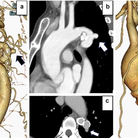 A Preoperative Contrast Enhanced Ct Scan A Saccular Aortic Aneurysm Is