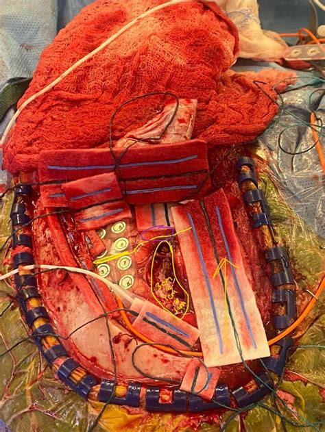 Successful Resection Surgery On Monday With Pics Repilepsy