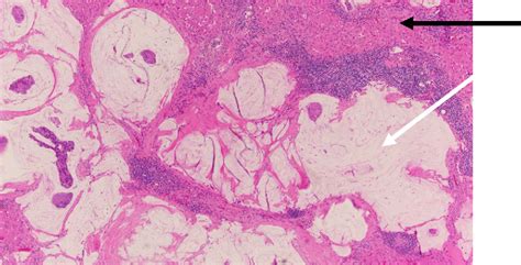 Figure 7 From Intrabiliary Metastasis Of Colorectal Mucinous Adenocarcinoma Mimicking