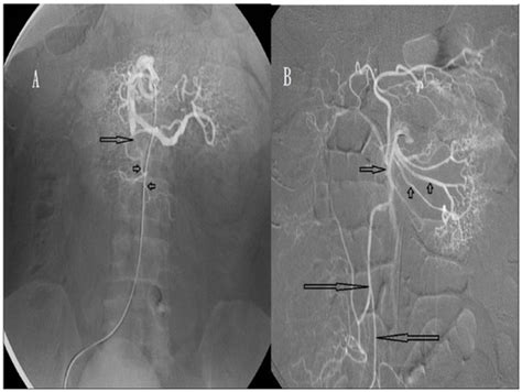 Intra Arterial Urokinase For Acute Superior Mesenteric Artery Occlusion
