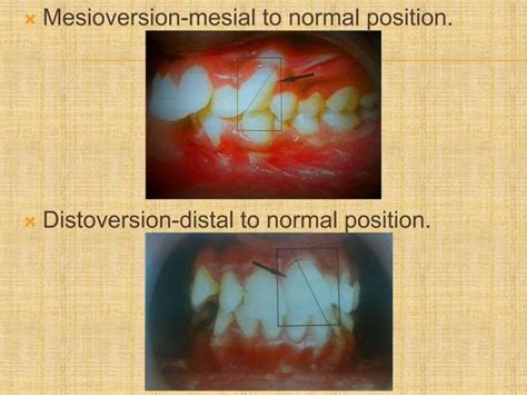 Modifications Of Angle`s Classification Pptx