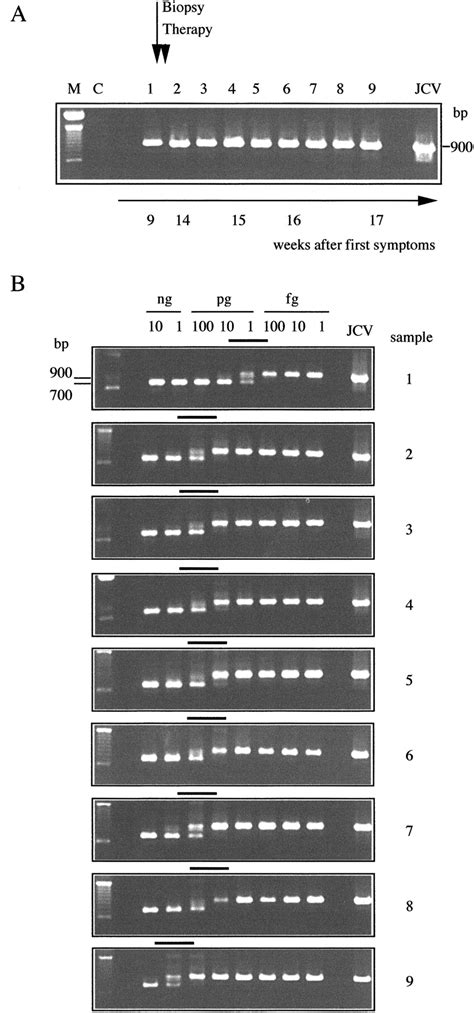Quantification Of The Jc Virus Jcv Dna Load In A Patient With A